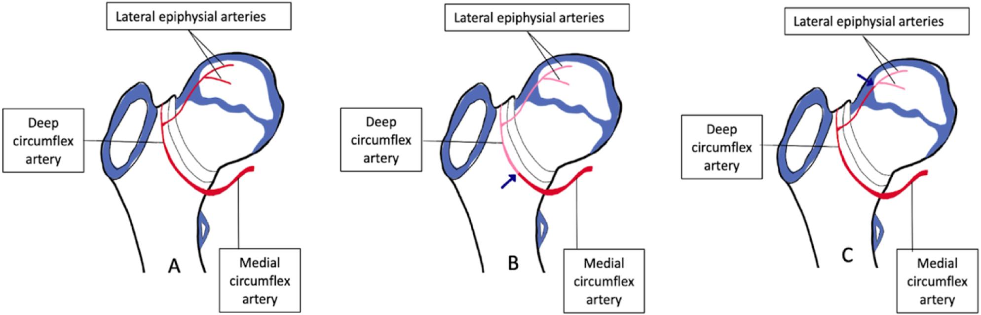 JBJS: Diagnosis and Management of Legg-Calvé-Perthes Disease in the ...
